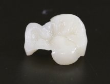 Expo dentaire - Prothèse conjointe composite